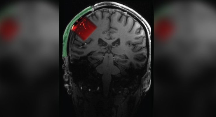 Caltech-Led Study Opens A Window Into the Brain – Pasadena Now